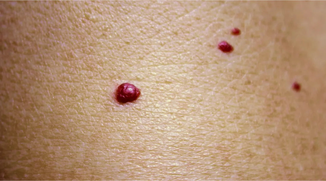 Comprendre l'apparition d'un petit point rouge sur la peau – Signature ...
